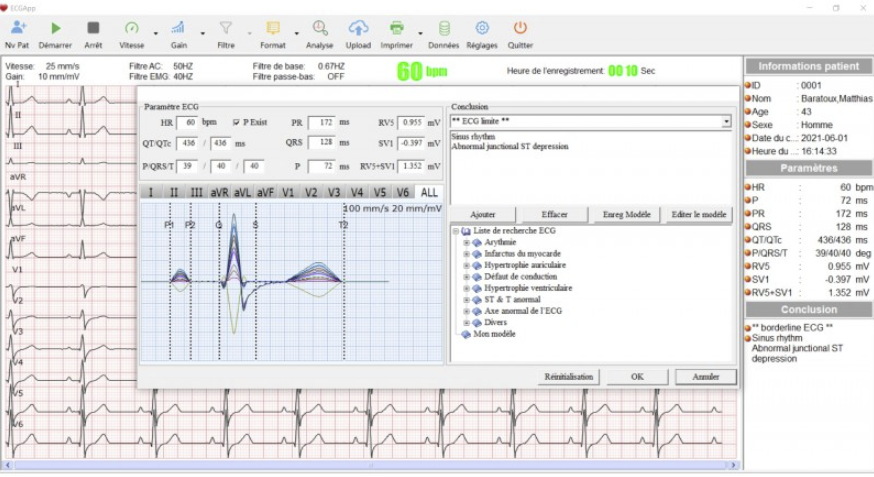 ECG digitale Spengler Cardiomate PC-ECG (12 canali)