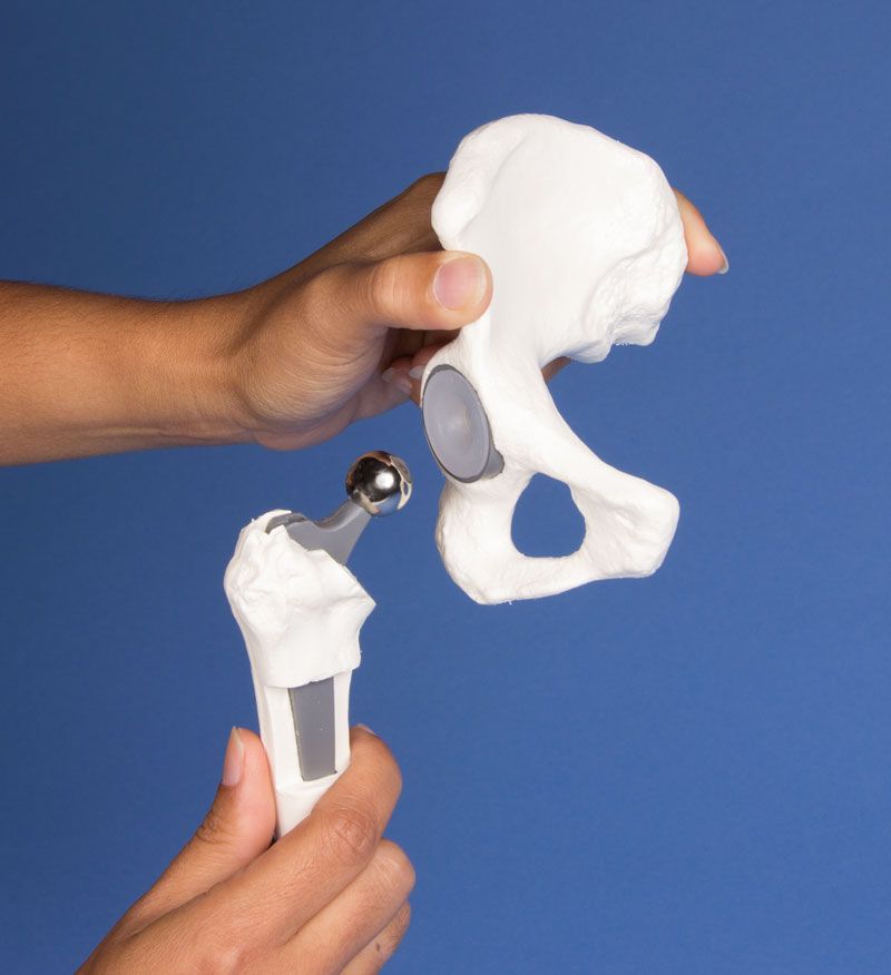 Modello di protesi dell' anca Erler Zimmer 1115 a 115